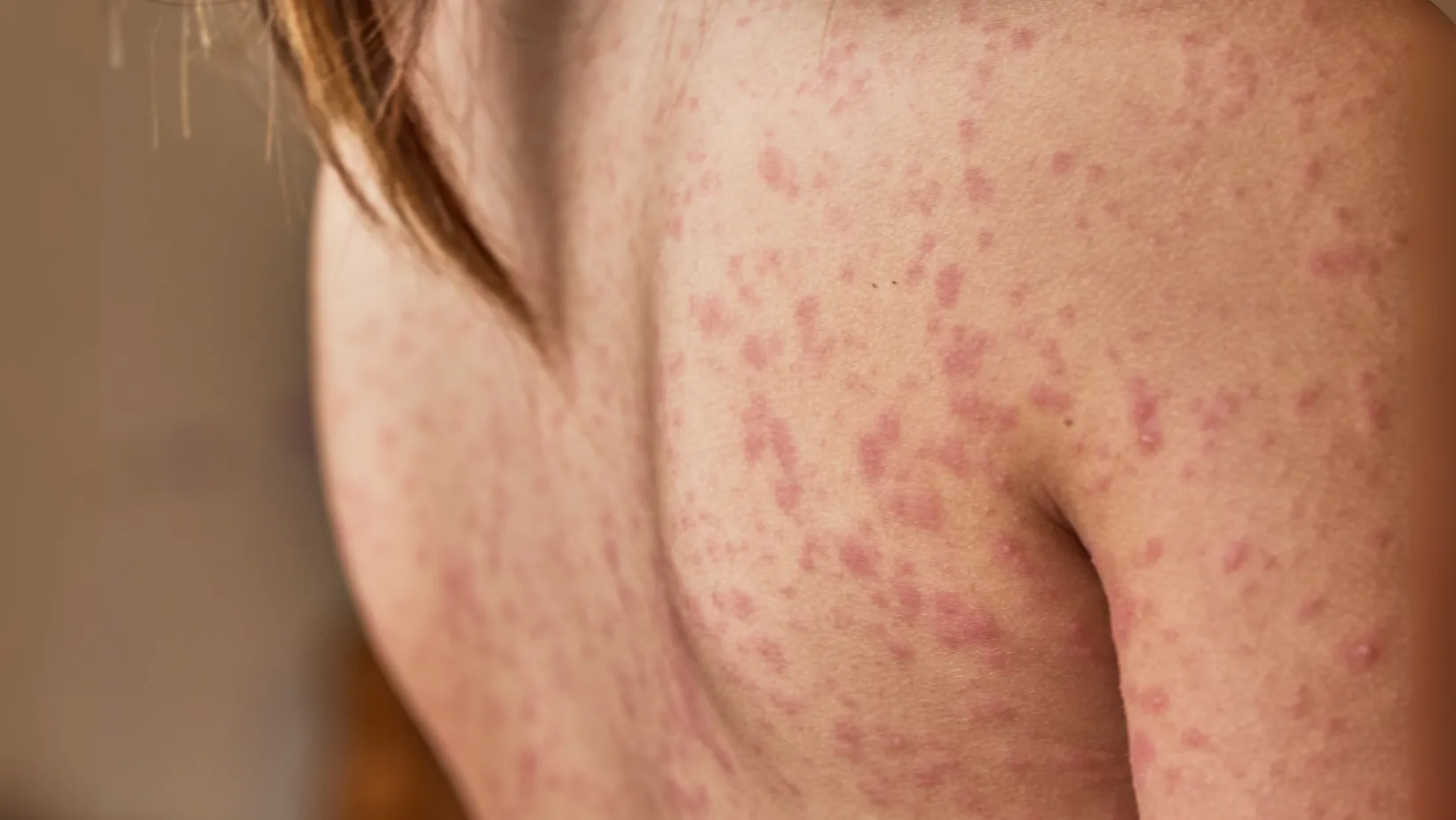Liver Disease Skin Rash: What It Means For Your Health | Dr. Nivedita ...